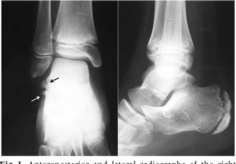 Figure 1 From Arthroscopic Excision Of Bone Fragments In A Neglected Fracture Of The Lateral