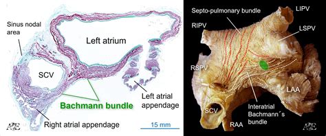 Iatrogenic Biatrial Flutter The Role Of The Bachmanns Bundle Cardiac Anatomy For