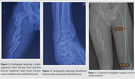 Triple Segmental Shaft Femur Fracture A Case Report Journal Of Orthopaedic Case Reports