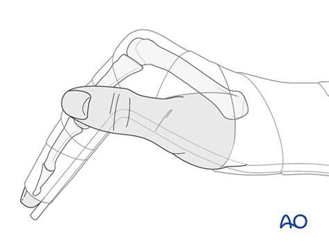 Nonoperative Treatment For Proximal Phalanx Metaphyseal Head Oblique