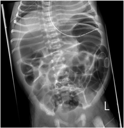 Diffuse Bowel Distention At Day 4 Of Life Associated With Bilious