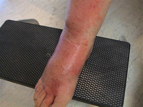 Bacterial Infections Cellulitis Bacterial Streptococcus Picture