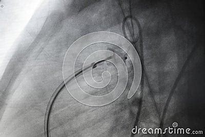 X Ray Image Perform PDA Device Closure After Treatment Patent Ductus Arteriosus Disease PDA