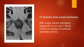 Anal Diseases Final Pptx