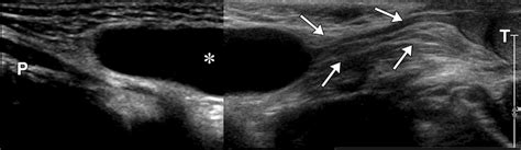 Noncommunicating Spermatic Cord Encysted Hydrocele In A 10 Month Old Download Scientific