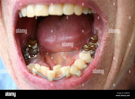 Close Up Of Elderly Womans Mouth And Teeth With Braces And Fillings