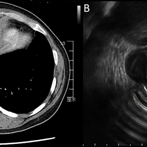 The Key Steps Of Ster A Endoscopic View Of E Gist B Submucosal