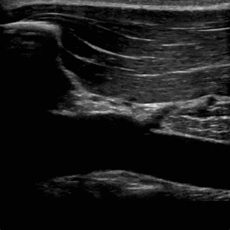 Subclavian Vein Ultrasound Subclavian Artery Ultrasound