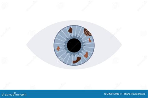 Iris Melanoma Anatomy Vector Illustration 329817008 Iris Melanoma Anatomy Vector Illustration 329817008