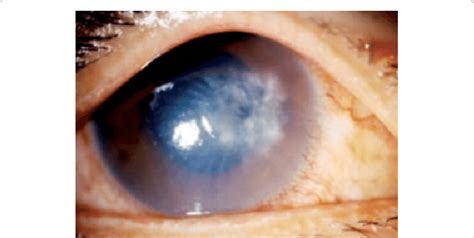 Ntm Atypical Keratitis Parasite