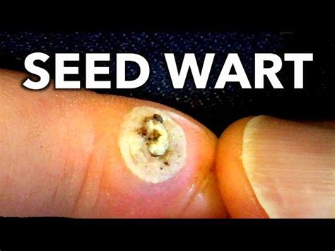 What Does A Plantar Wart Seed Look Like