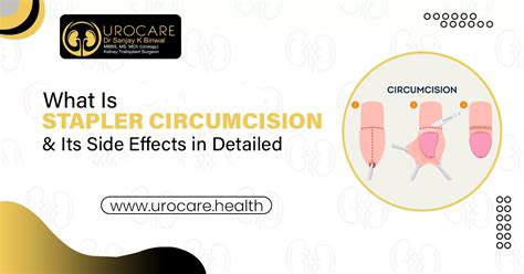 Revolutionary Stapler Circumcision: Benefits, Procedure & Potential Side Effects