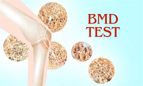 Bone Mineral Density Test In Udaipur Best Diagnostic Center In