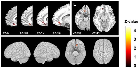 Sagittal And Transverse Sections Of The Statistical Parametric Map Of