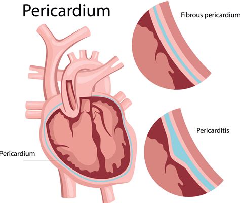 Transcutaneous Pacing Acls Certification Association