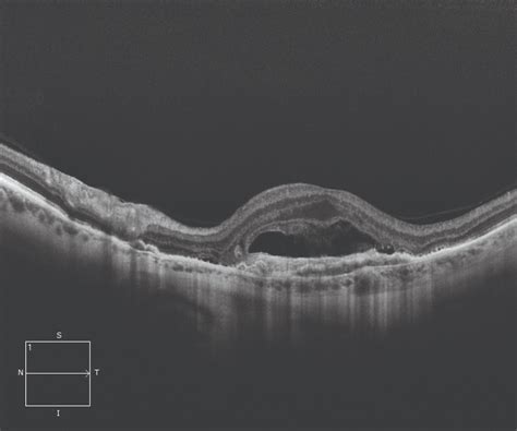 Specialist Intravitreal Injections At Eagle Eye Surgeons