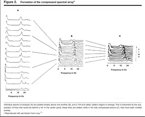 Figure 2 From Perioperative Monitoring With The Electroencephalogram And The Bispectral Index