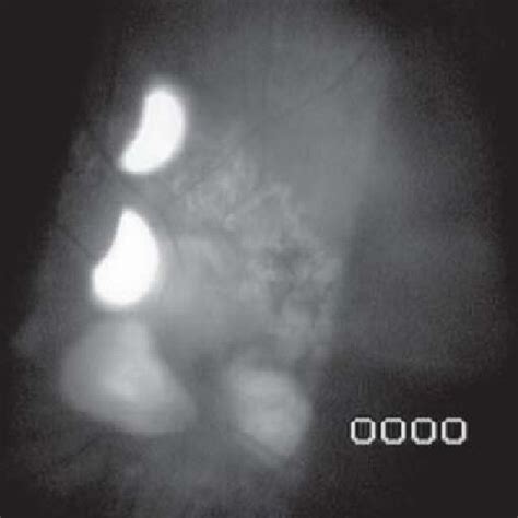 Pdf Ocular Toxocariasis A Case Report