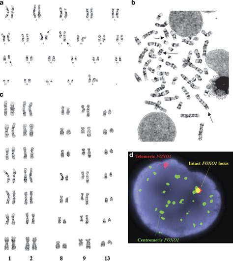 Abnormal Cytogenetic Findings In The Tumor Cells A Representative