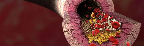 Mooci Arteriosklerose Auslöser Für Einen Herzinfarkt