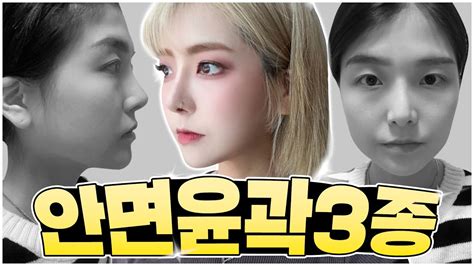 [안면윤곽] 단발이 잘 어울리는 얼굴형 되기 성형비포애프터 에이비성형외과 Youtube