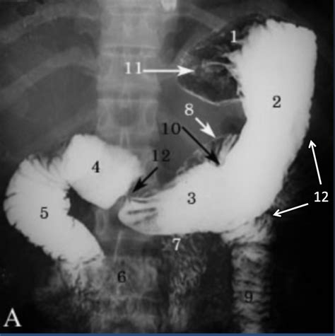 Dsa 08 Normal Double Contrast Ugi Study Diagram Quizlet