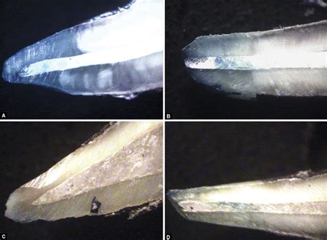 Comparative Evaluation Of Microleakage Of Zinc Oxide Eugenol And Endoflas As Obturating
