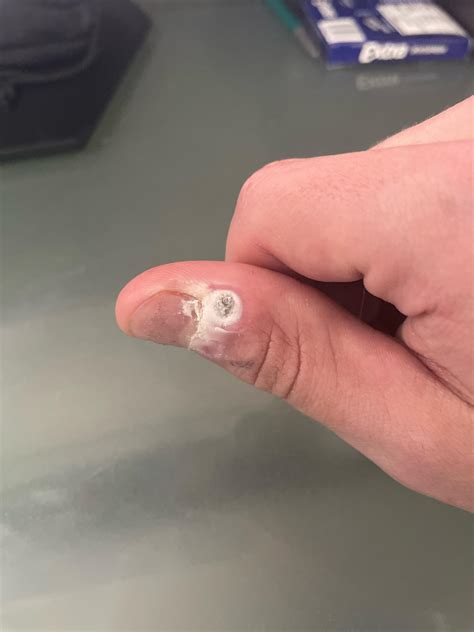 Is This Normal R Warts