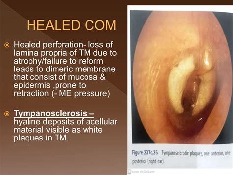 Chronic Suppurative Otitis Media Disease Of Ear Pptx