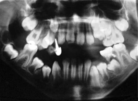 Clinical Aspects Of Congenital Syphilis With Hutchinsons Triad Bmj