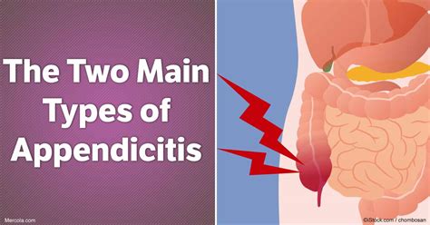 The Two Main Types Of Appendicitis