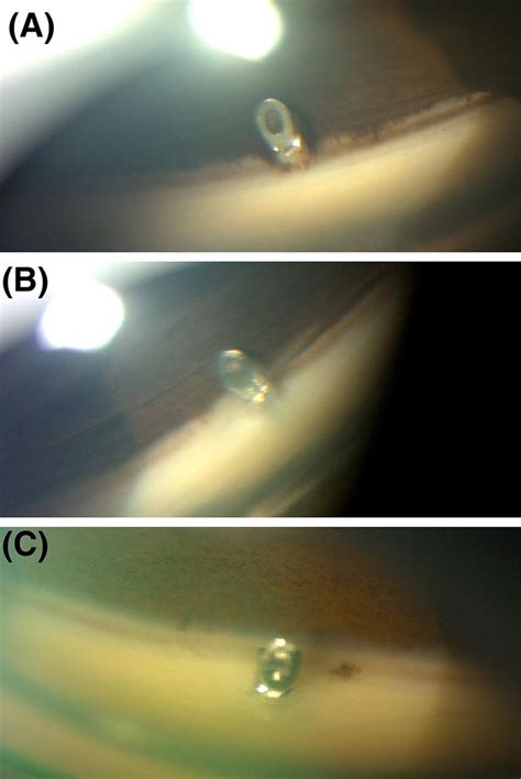 Example Of The Insertion Position Of The Ex Press Device A The Download Scientific Diagram