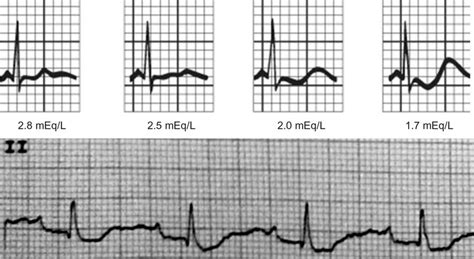 Electrocardiographic Tracings With Hypokalemia And