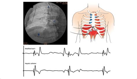 set up for cmap recording left upper catheters positions on an