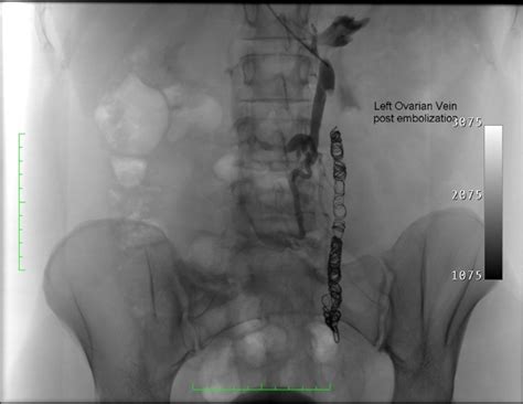 Ovarian Vein Embolisation Specialist Endovascular Services