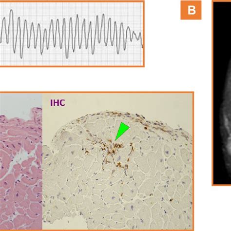 Arrhythmic Myocarditis Acute Hot Phase Example Of Acute Arrhythmic