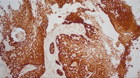 P16 Ihc Control Squamous Cell Carcinoma Of Cervix 10x Showing 90 Download Scientific