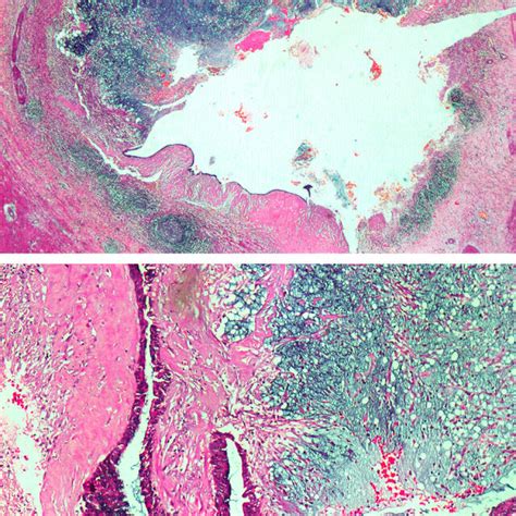 A Low Grade Appendiceal Neoplasm Magnification 2x Of He Stained