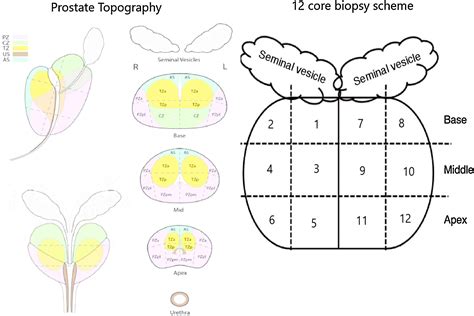 Accuracy Of ADC Ratio In Discriminating True And False Positives In Multiparametric Prostatic