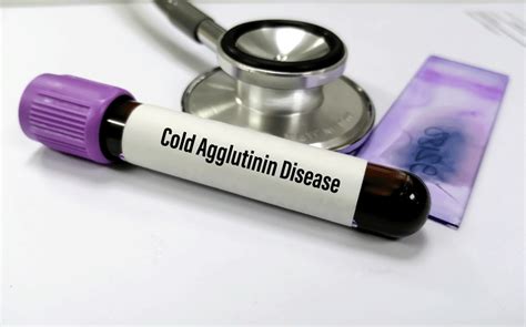 Sutimlimab Approved In Europe For Cold Agglutinin Haemolytic Anaemia Hospital Healthcare Europe