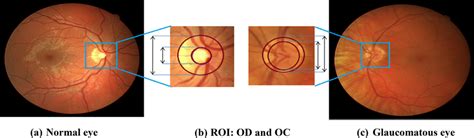 Retinal Structures In Normal Vs Glaucoma Fundus Images Download Scientific Diagram