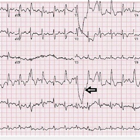 Ekg Showing Intraventricular Block Download Scientific Diagram