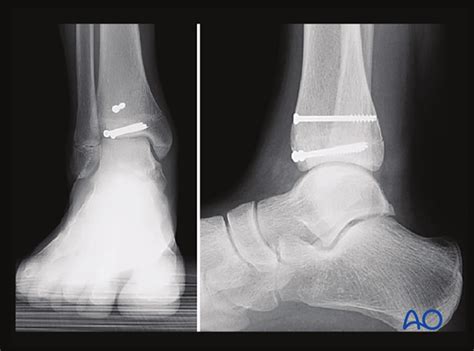 Open Reduction Screw Fixation For Complex Epi Metaphyseal Fractures Of The Distal Tibia Triplane