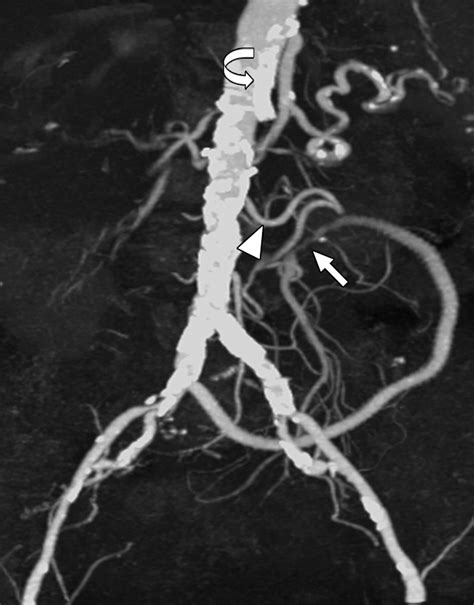 Mdct Angiography Of Mesenteric Bypass Surgery For The Treatment Of