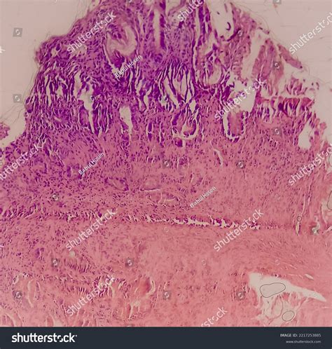 Sigmoid Coloncolonoscopic Biopsy Chronic Nonspecific Colitis Stock