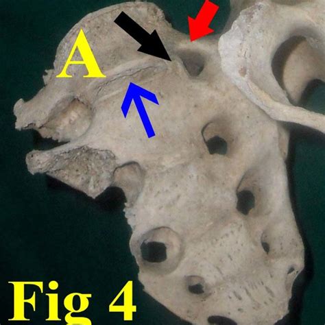 Showing Bilateral Sacralization A 5 Th Lumbar Vertebra Red Colour