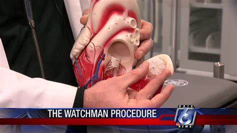 Cutting Edge Watchman Procedure Used To Correct A Fib Youtube