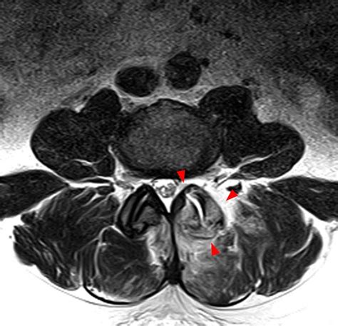 Facet Synovitis Radsource