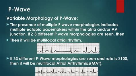 Atrial Enlargement Left And Right Atrial Enlargement And P Wave