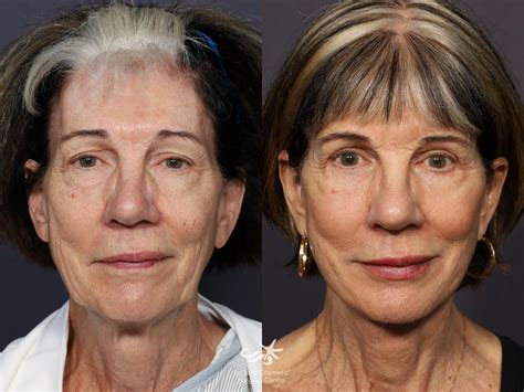 Facelift In San Diego Ca La Jolla Cosmetic Surgery Centre